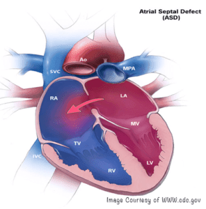 Robotic Mitral Valve Repair or Replacement Surgery- Mics