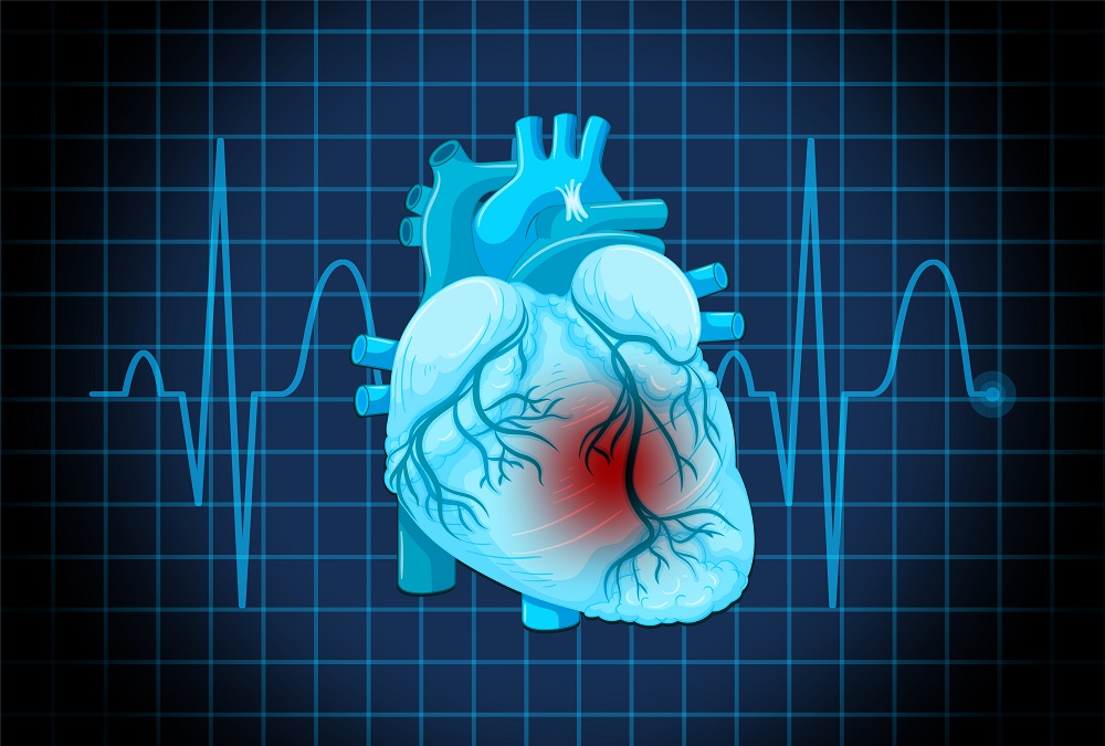 Overview of Robotic Heart Surgery: Types, Treatment, Recovery ...